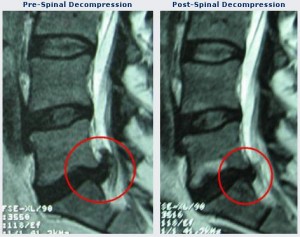 Spinal Disc Bulge Herniation | Sherrod Chiropractic, PLC